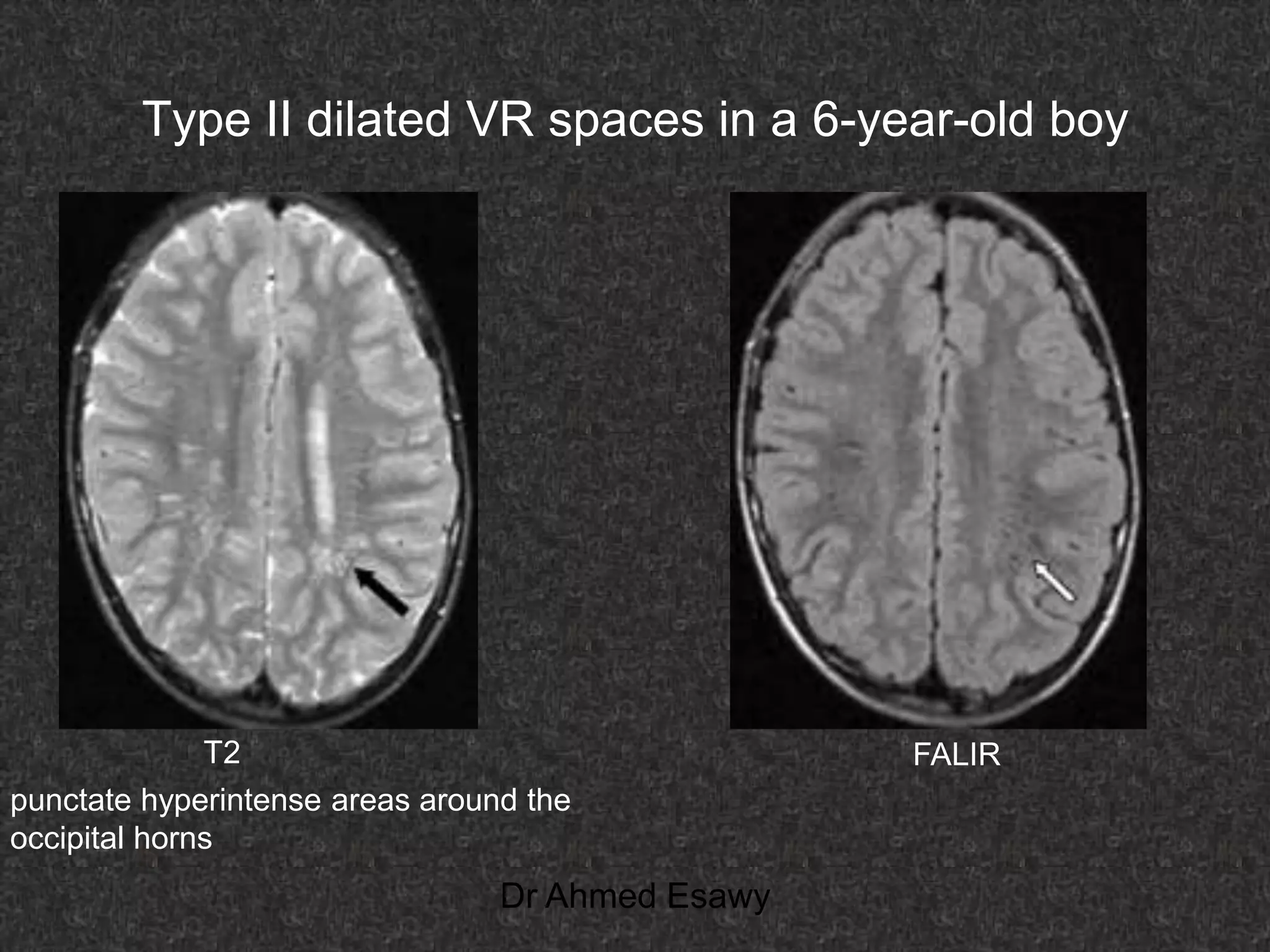 Intracranial non neoplastic cystic lesion Dr Ahmed Esawy CT MRI part 5 ...