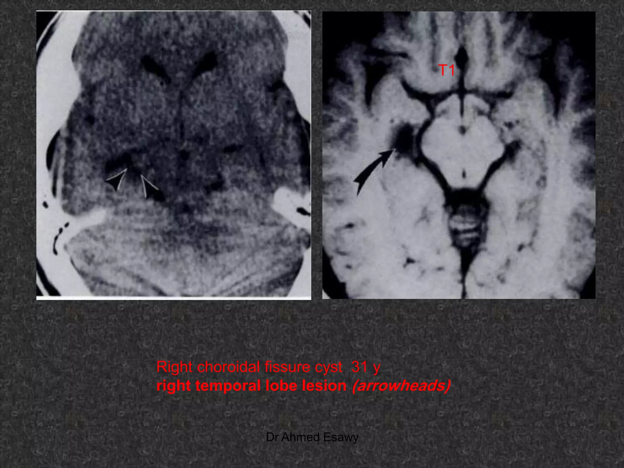 Intracranial non neoplastic cystic lesion Dr Ahmed Esawy CT MRI part 5 ...