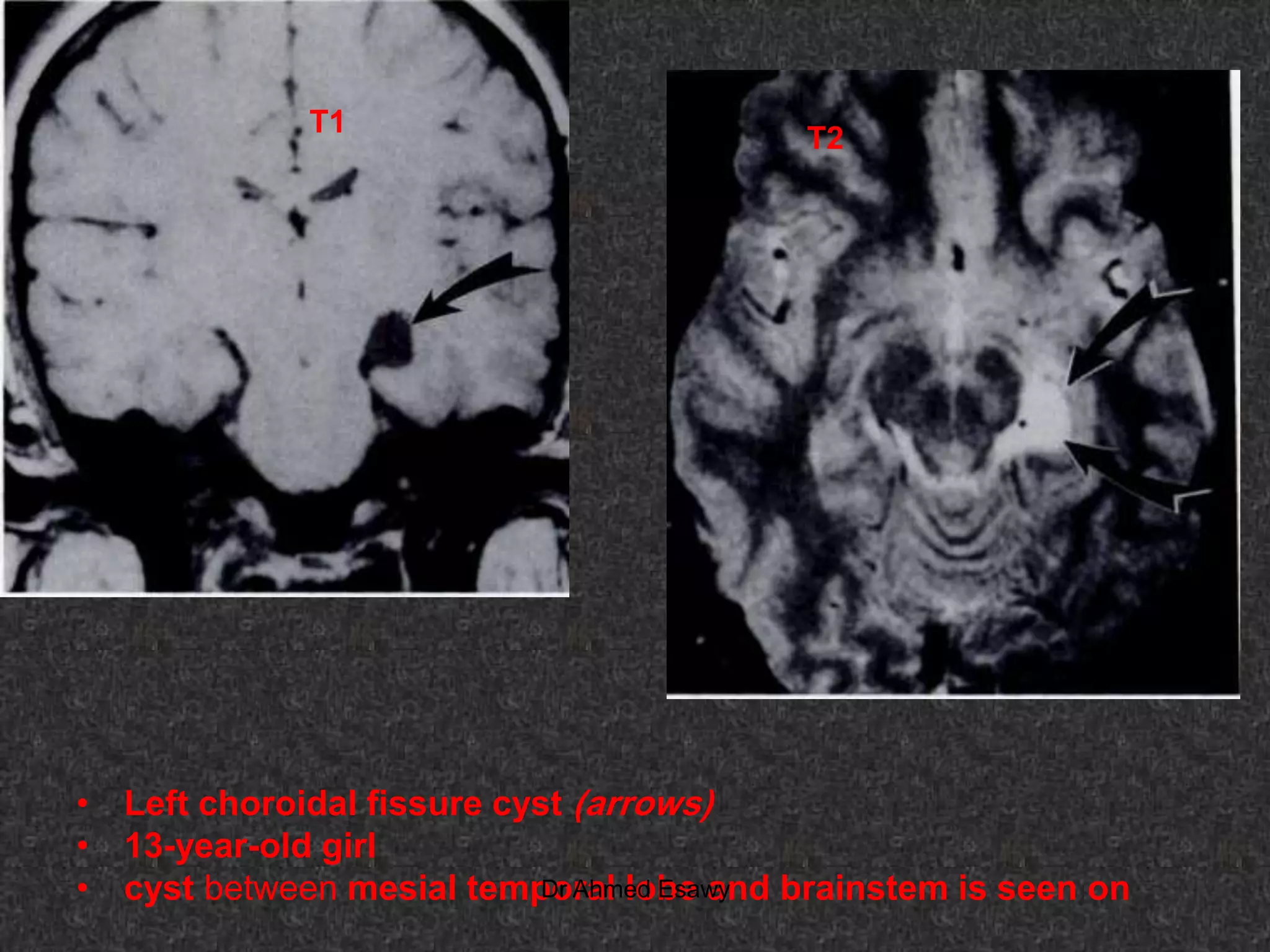 Intracranial non neoplastic cystic lesion Dr Ahmed Esawy CT MRI part 5 ...