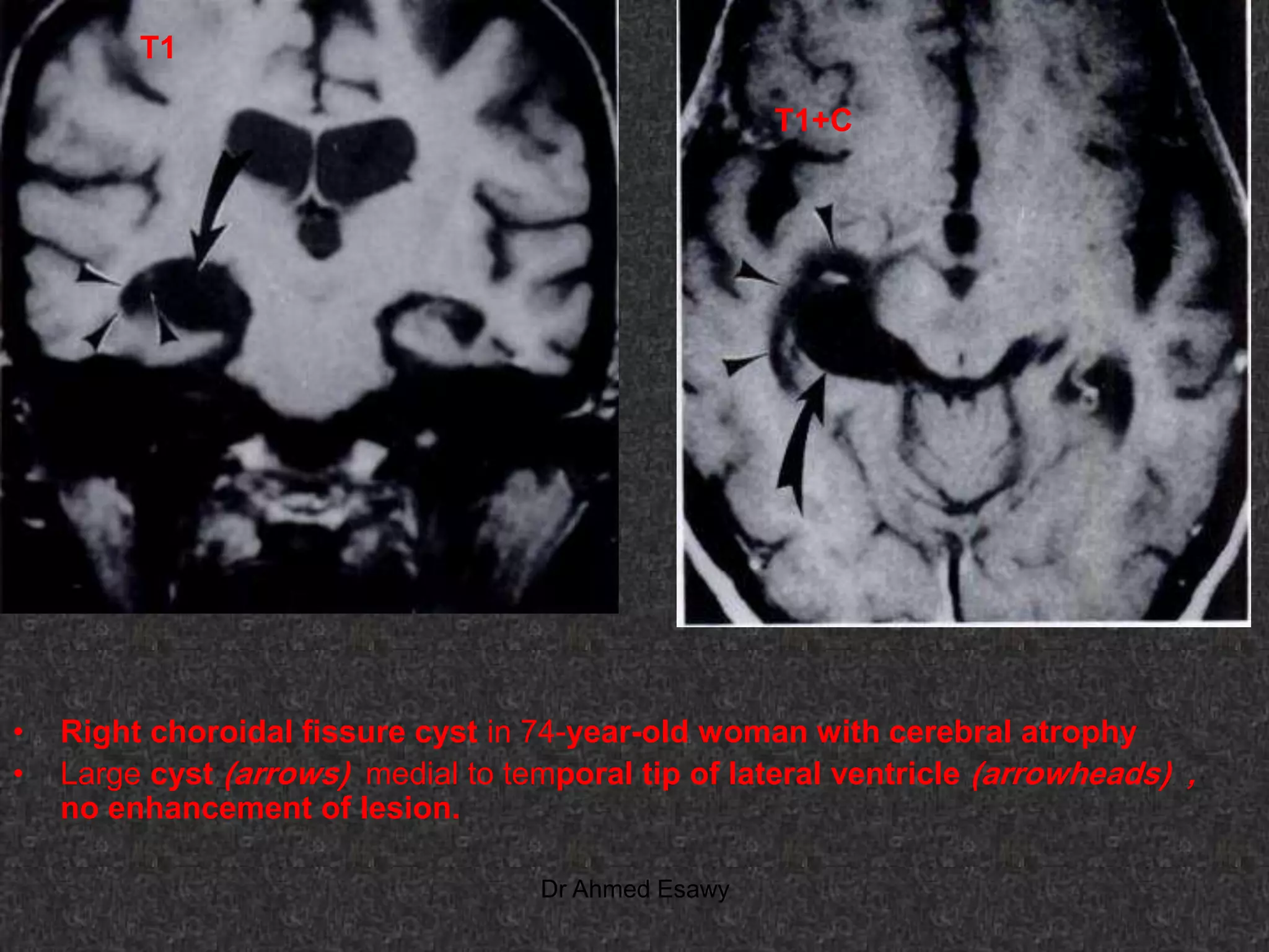 Intracranial non neoplastic cystic lesion Dr Ahmed Esawy CT MRI part 5 ...