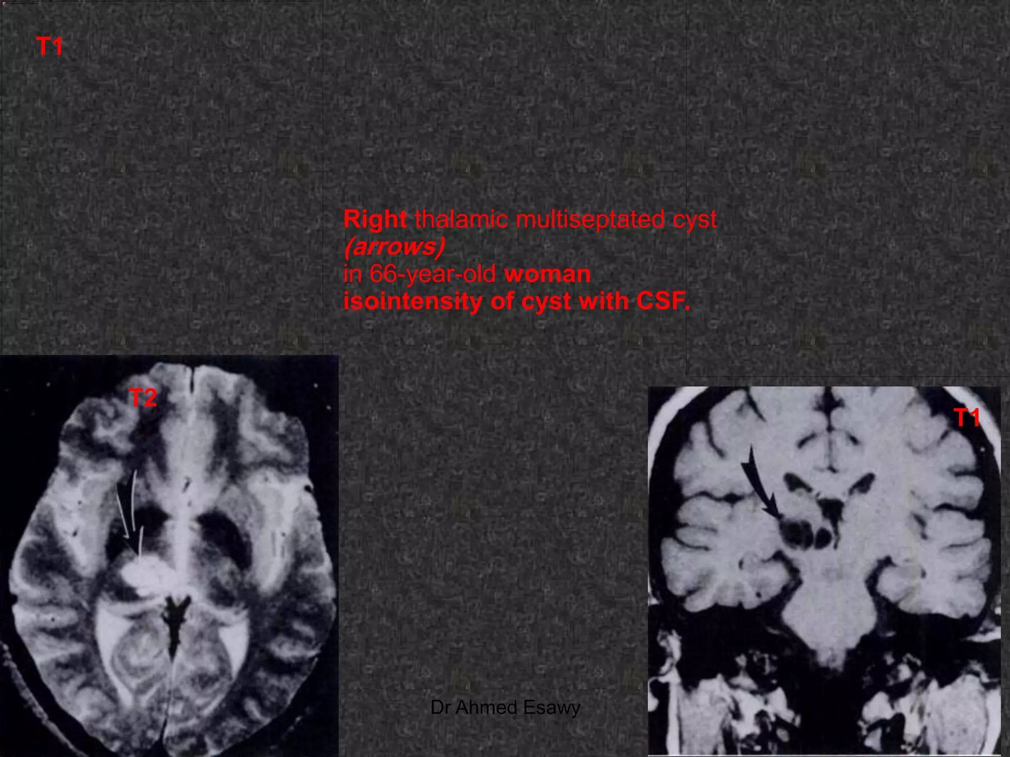 Intracranial non neoplastic cystic lesion Dr Ahmed Esawy CT MRI part 5 ...