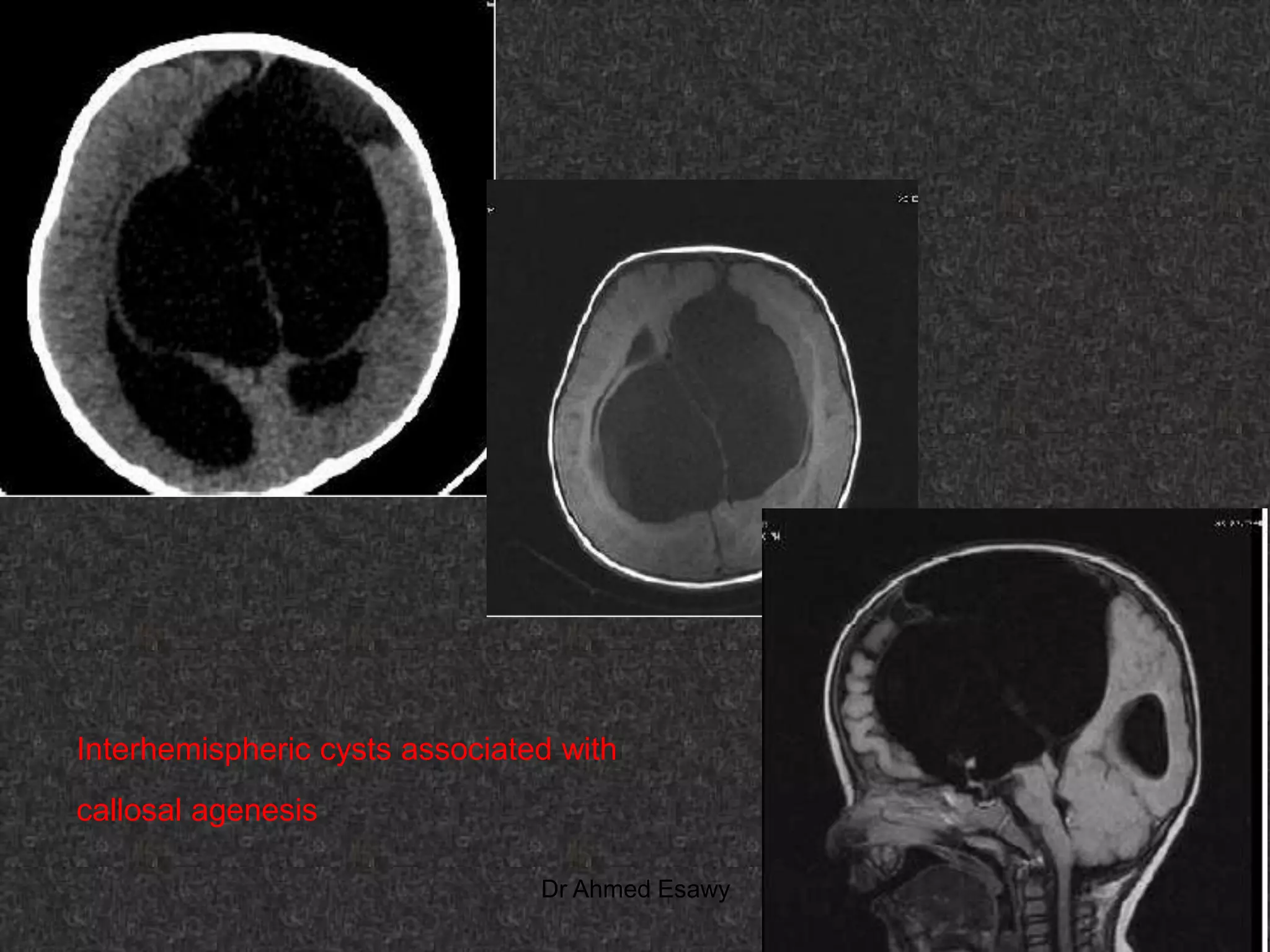 Intracranial non neoplastic cystic lesion Dr Ahmed Esawy CT MRI part 5 ...