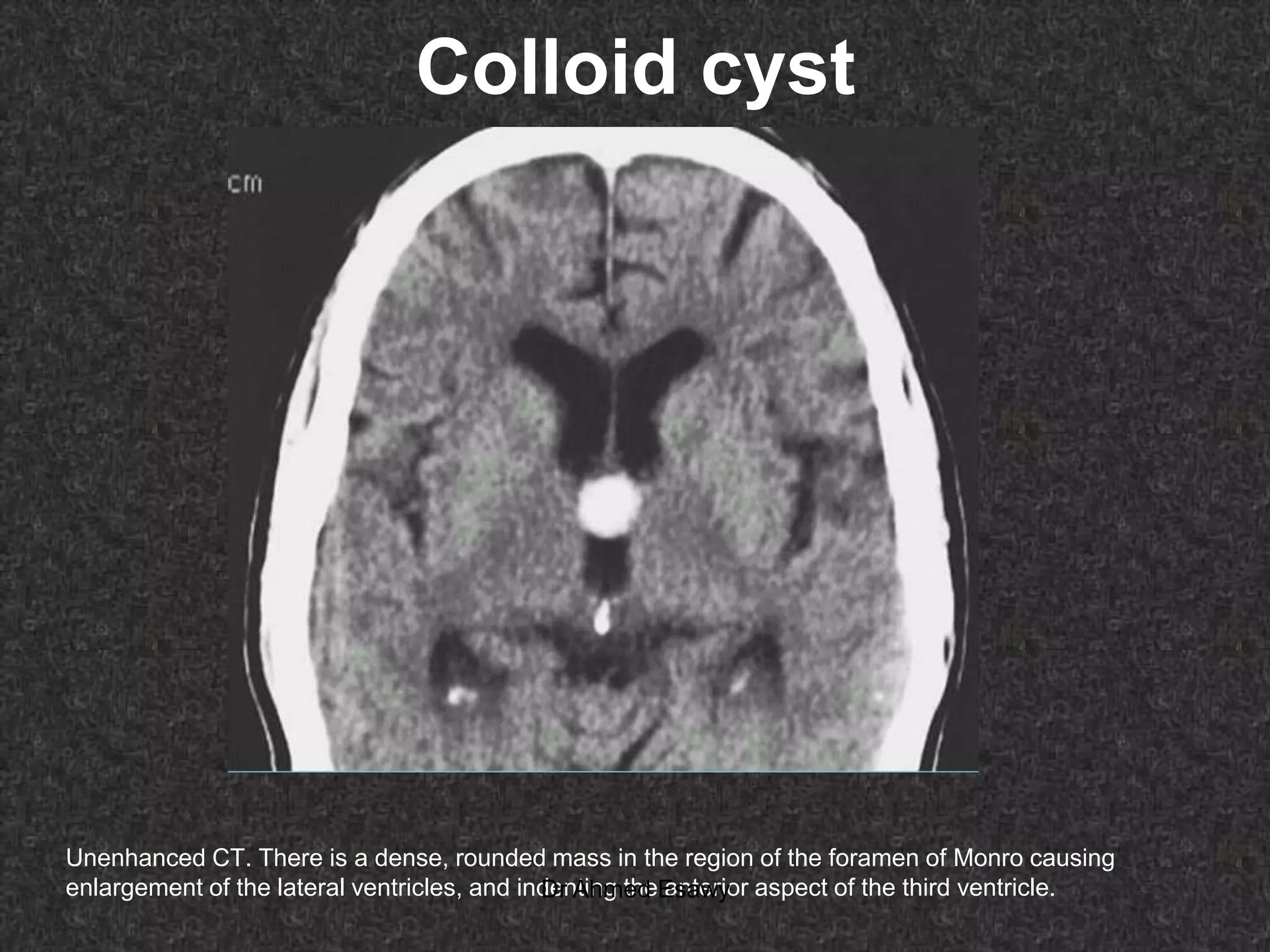 Intracranial non neoplastic cystic lesion Dr Ahmed Esawy CT MRI part 5 ...