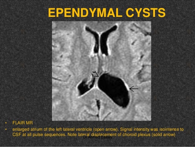 Intracranial non neoplastic cystic lesion Dr Ahmed Esawy CT MRI part…