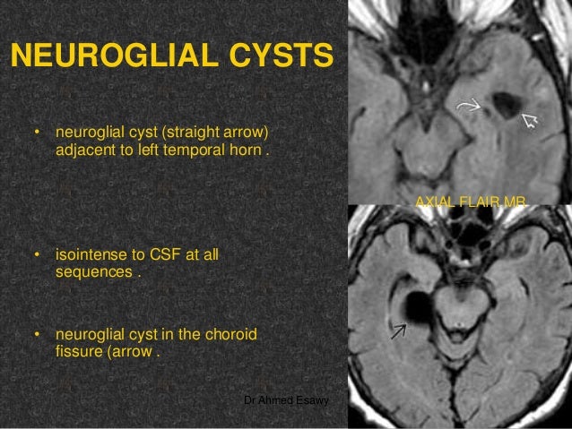 Intracranial non neoplastic cystic lesion Dr Ahmed Esawy CT MRI part…