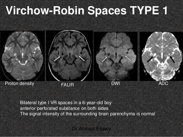 Intracranial non neoplastic cystic lesion Dr Ahmed Esawy CT MRI part…