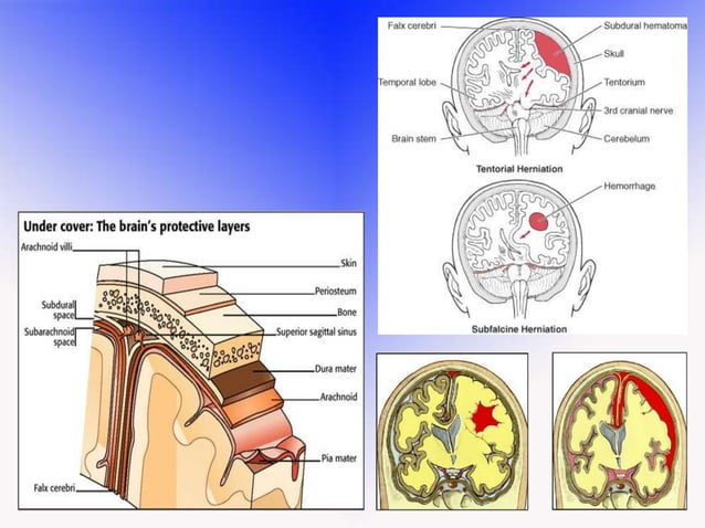 Intra cranial pressure | PPSX