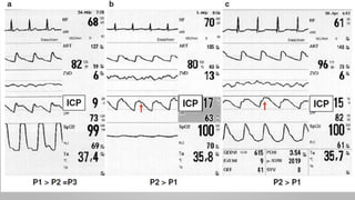 Intra cranial pressure | PPTX