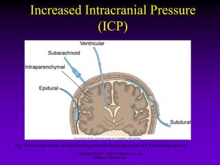 intracranialpressure.ppt