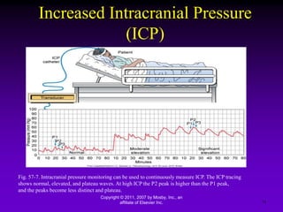 intracranialpressure.ppt