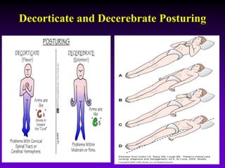 intracranialpressure.ppt