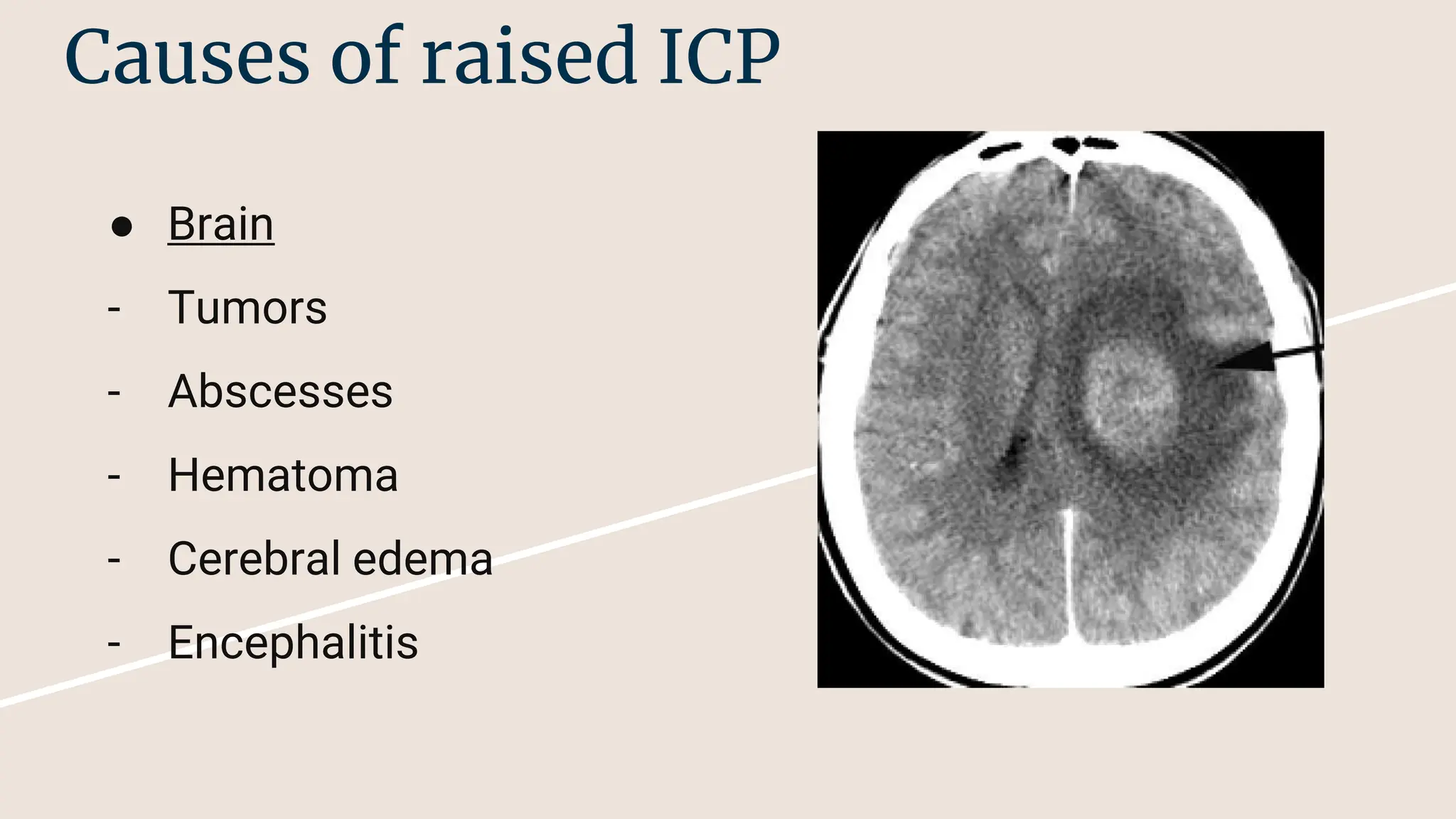 INTRACRANIAL PRESSURE- pathogenesis and management | PPTX