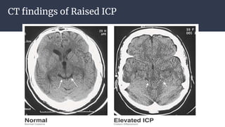 INTRACRANIAL PRESSURE- pathogenesis and management | PPTX