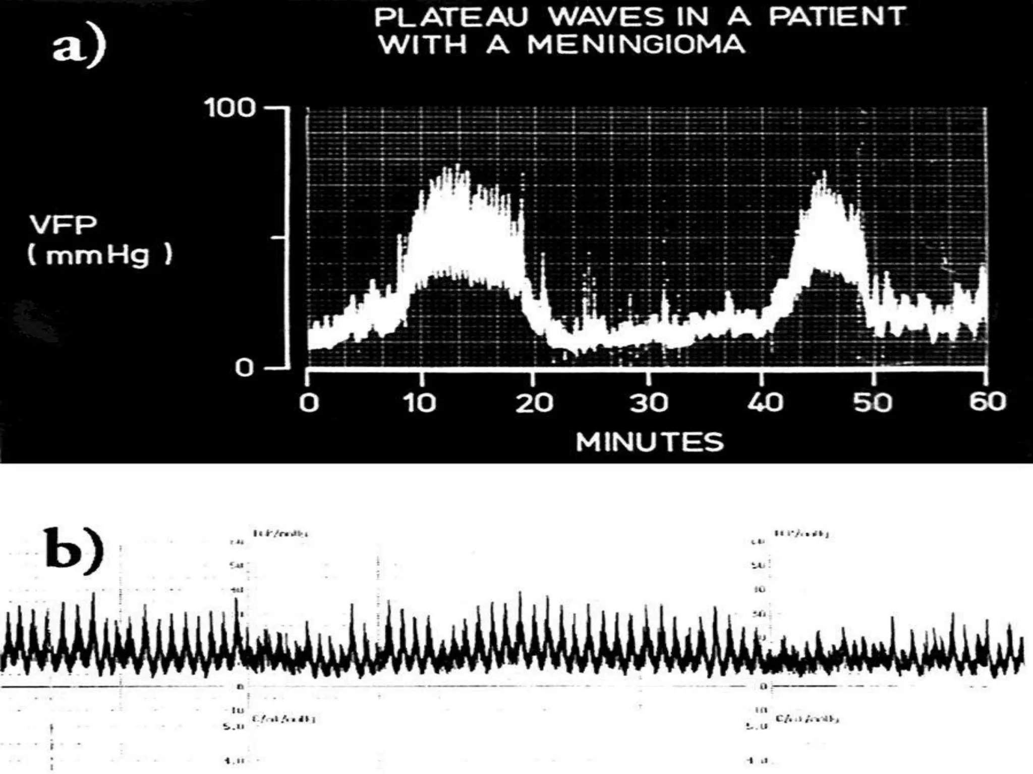 Intracranial pressure measurement | PPTX