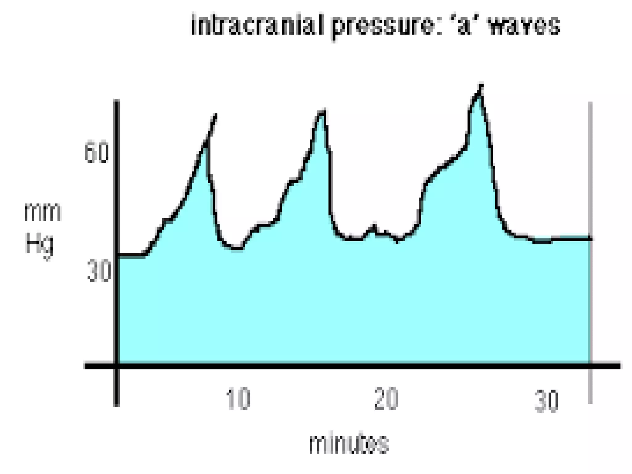 Intracranial pressure measurement | PPTX