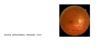 Intracranial Pressure Monitoring 4PS.pptx