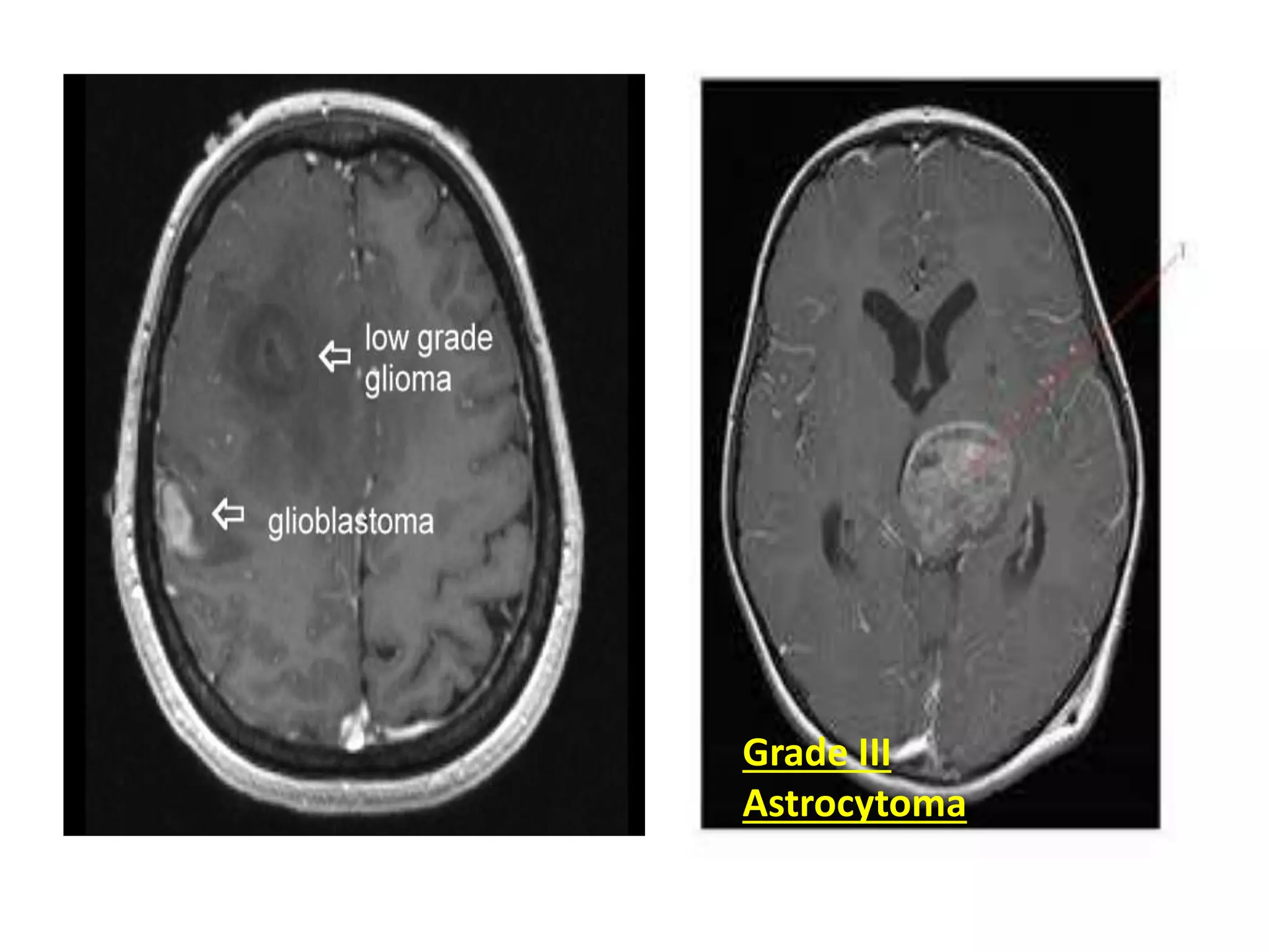 Intracranial space occupying lesions | PPTX