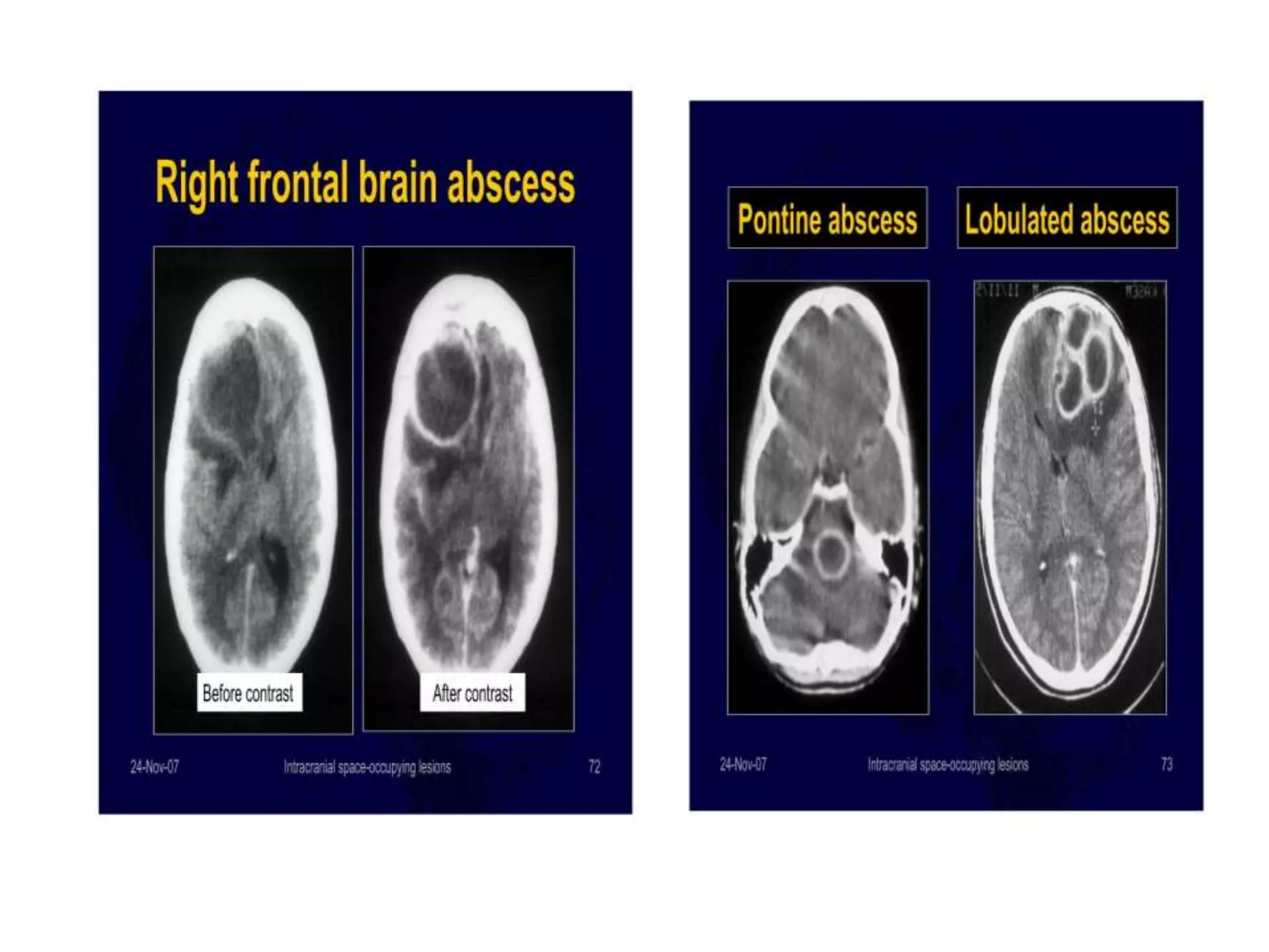 Intracranial space occupying lesions | PPTX
