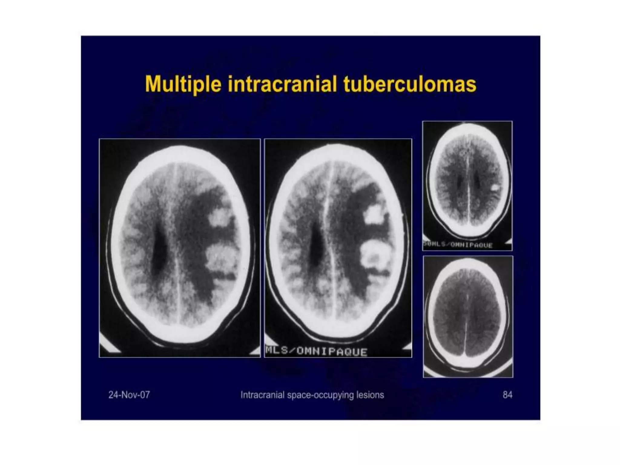 Intracranial space occupying lesions | PPTX