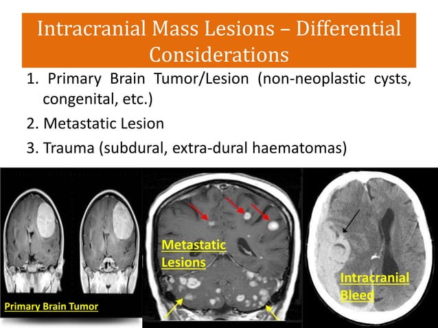 Intracranial space occupying lesions | PPT