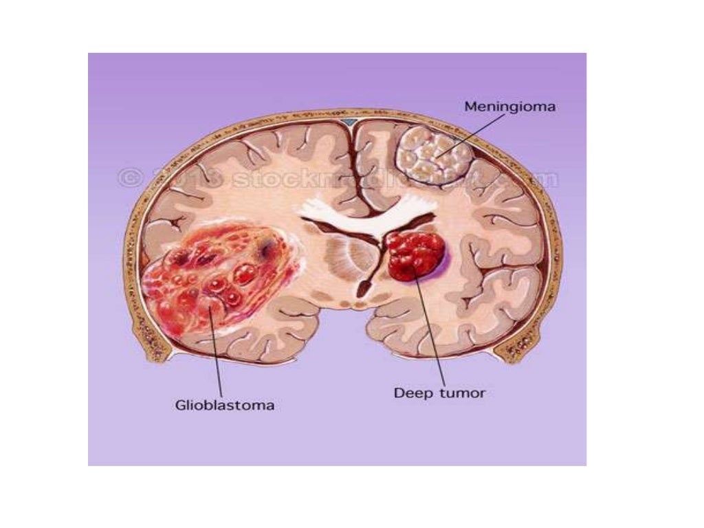 Intracranial space occupying lesions
