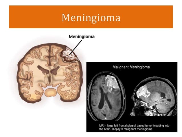 Intracranial Space Occupying Lesions
