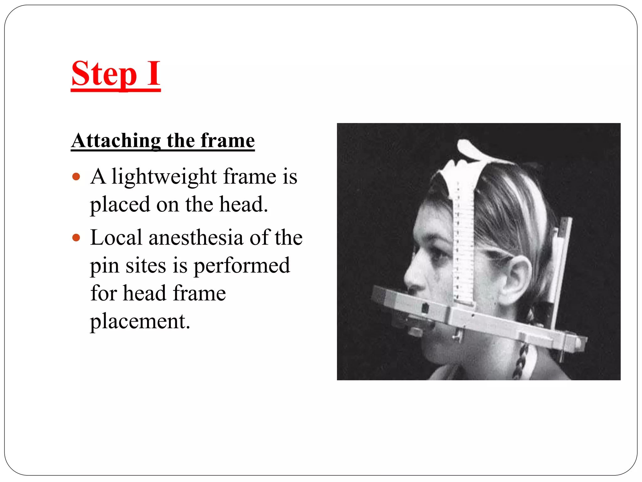 Intracranial stereotactic radiosurgery | PPTX