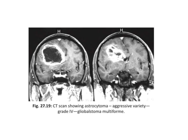 intracranial tumors presentation final.pptx | Brain and Nervous System ...