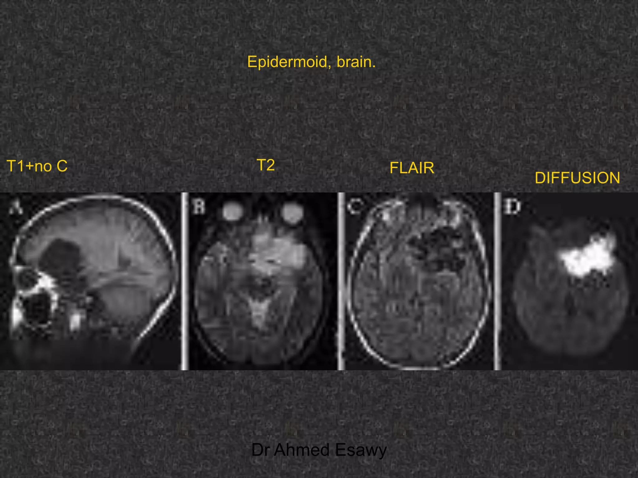 Intracranial tumour&tumour like cystic lesion Dr Ahmed Esawy CT MRI 6 ...