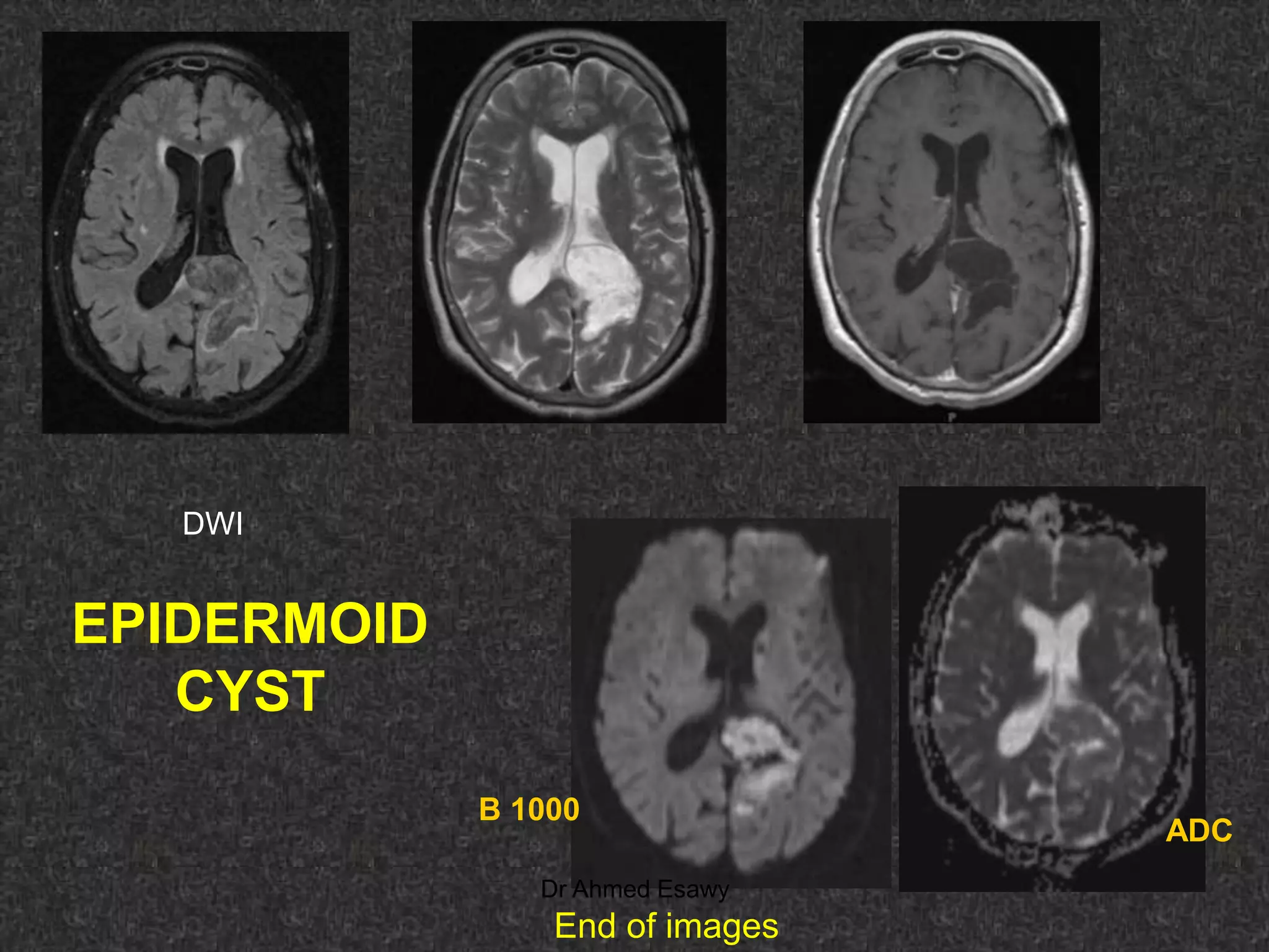 Intracranial tumour&tumour like cystic lesion Dr Ahmed Esawy CT MRI 6 ...