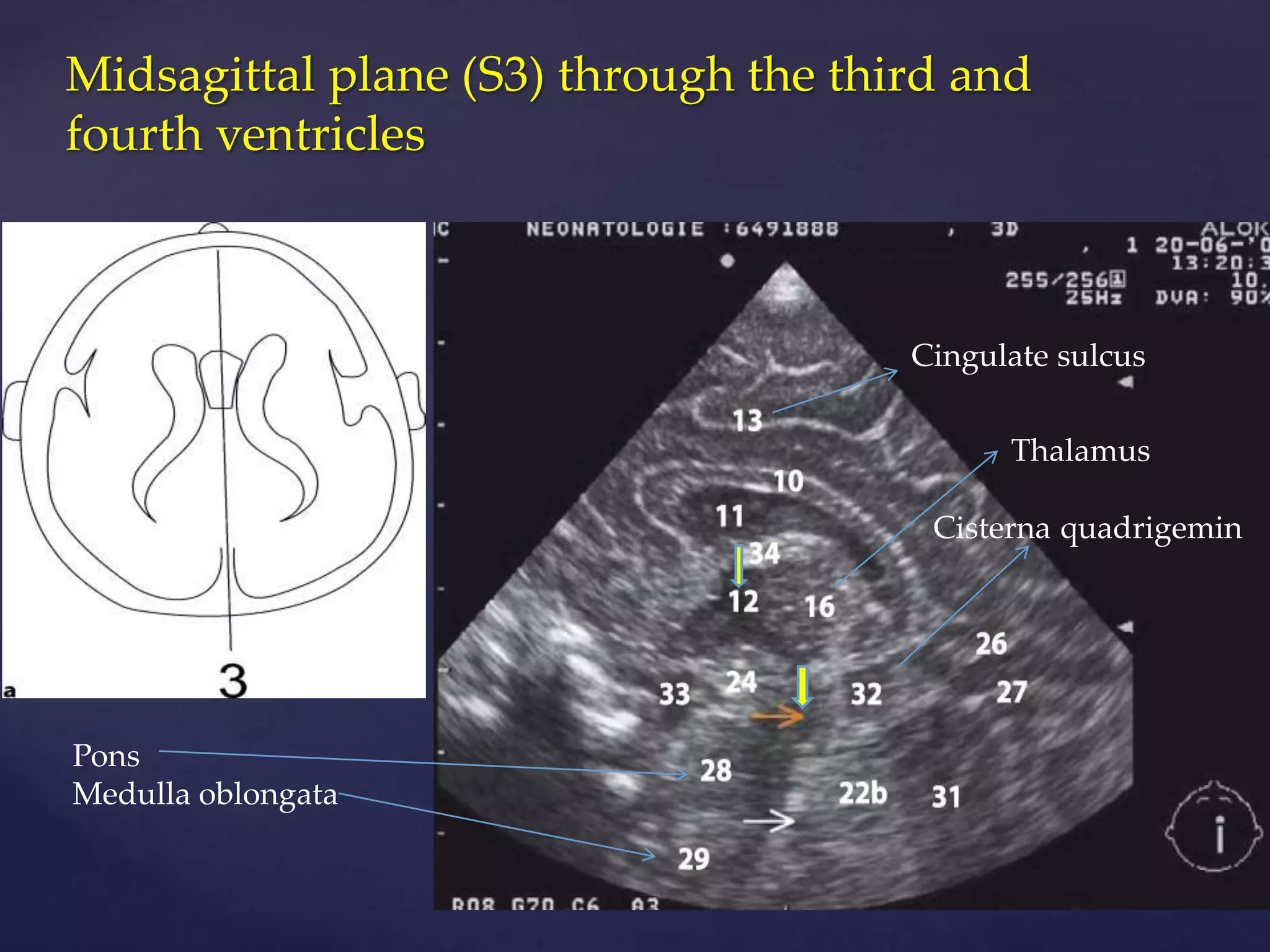 Intracranial ultrasound | PPTX