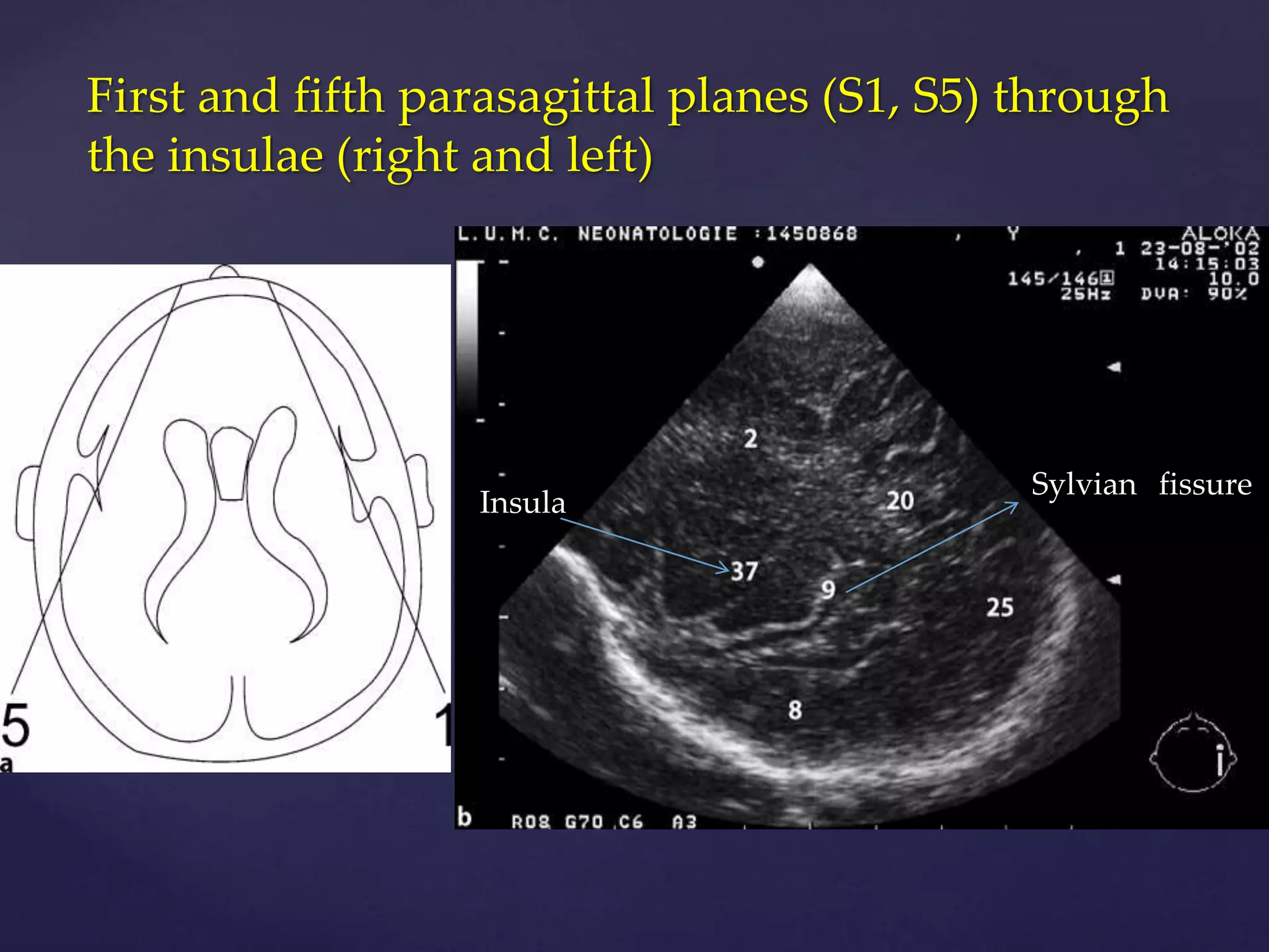 Intracranial ultrasound | PPTX