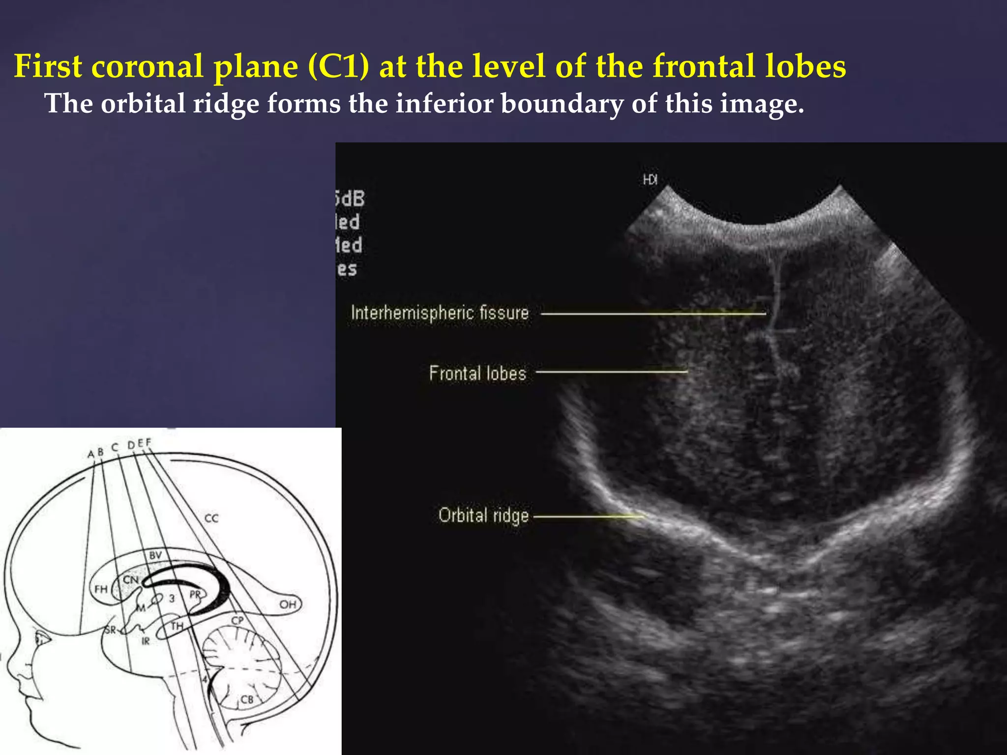 Intracranial ultrasound | PPTX