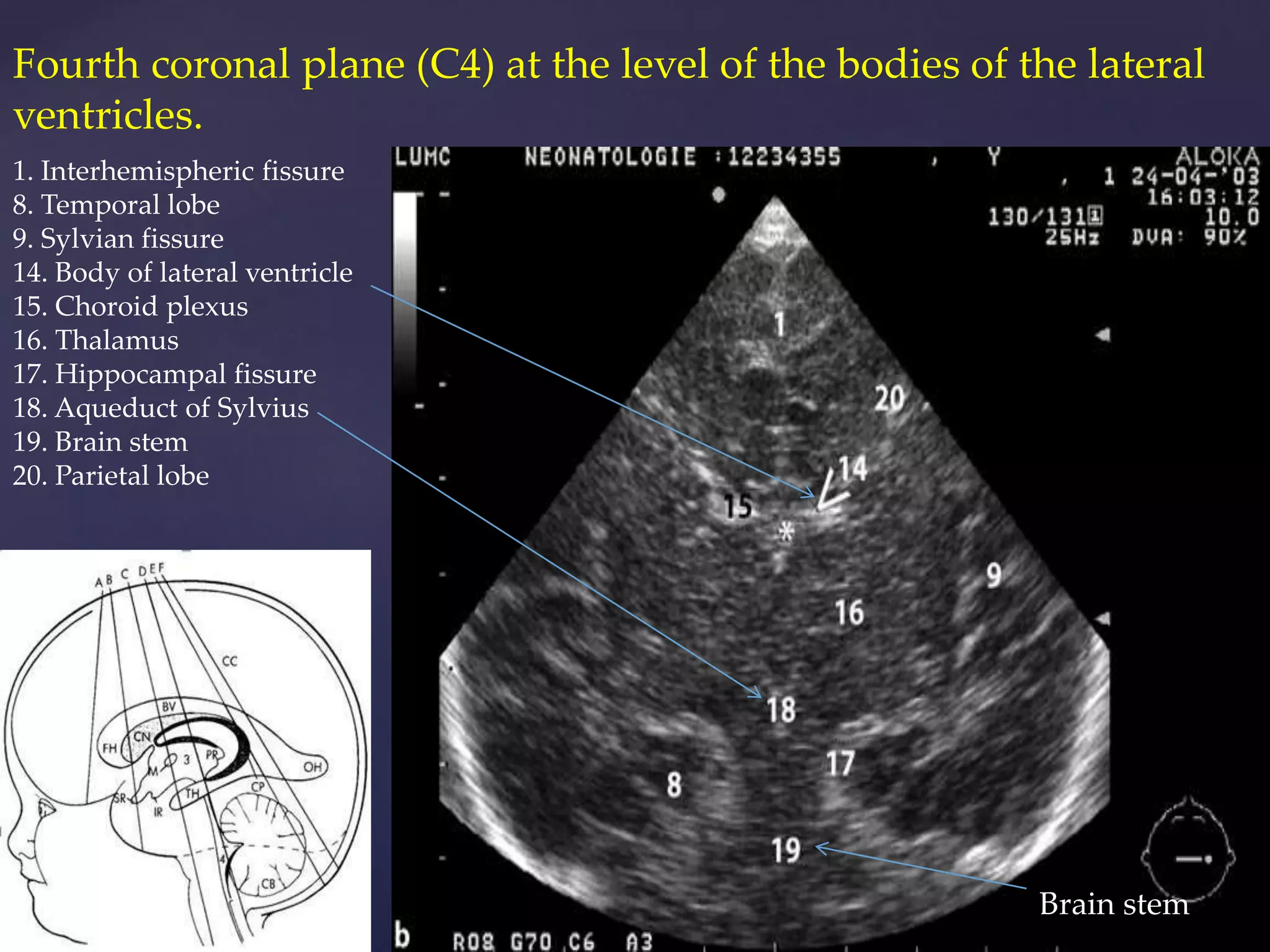 Intracranial ultrasound | PPTX