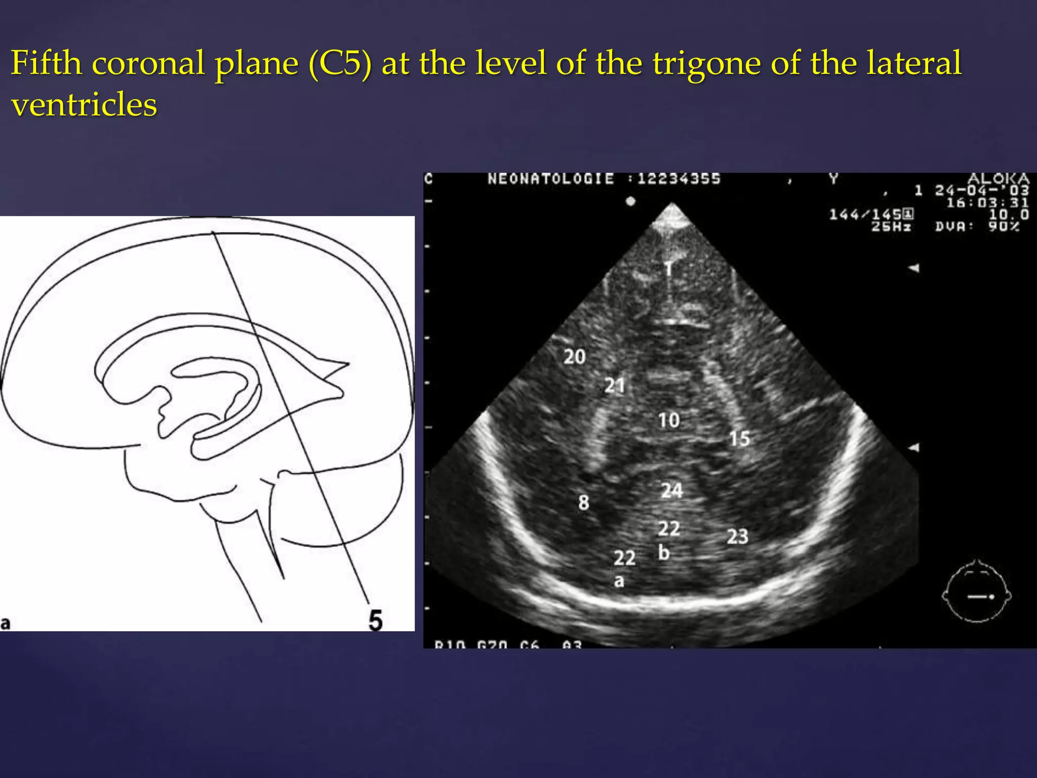 Intracranial ultrasound | PPTX