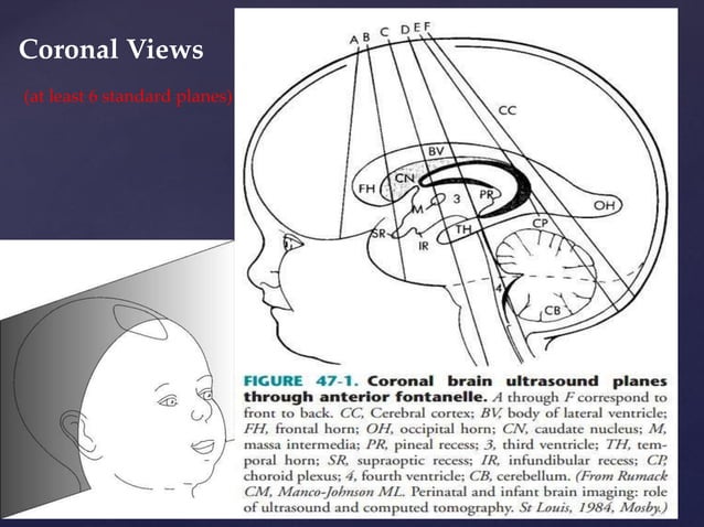Intracranial ultrasound | PPTX
