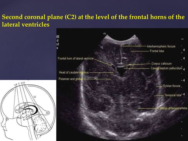 Intracranial ultrasound | PPTX
