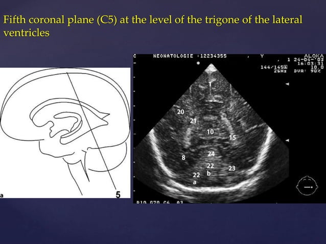 Intracranial ultrasound | PPTX