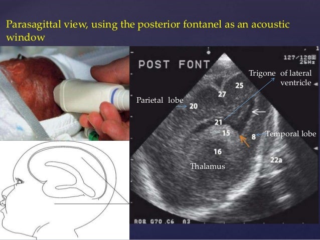 Intracranial ultrasound