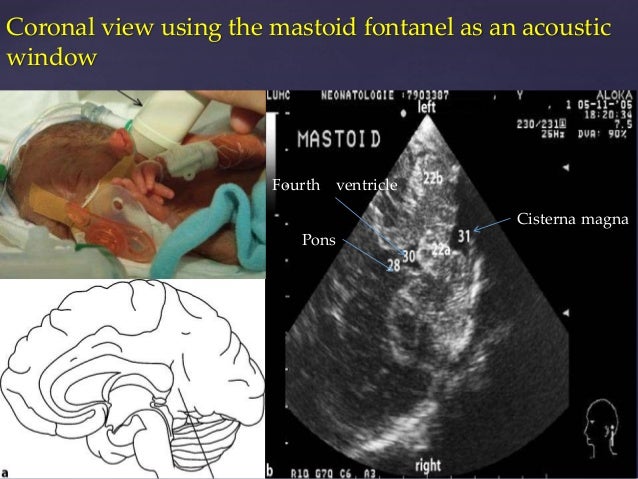 Intracranial ultrasound