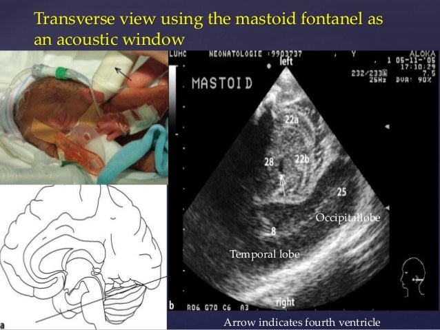 Intracranial ultrasound