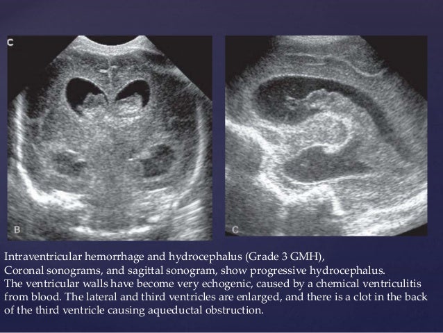 Intracranial ultrasound