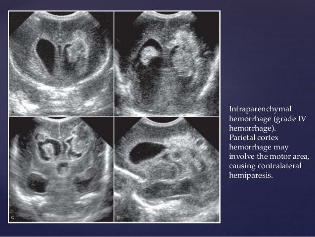 Intracranial ultrasound