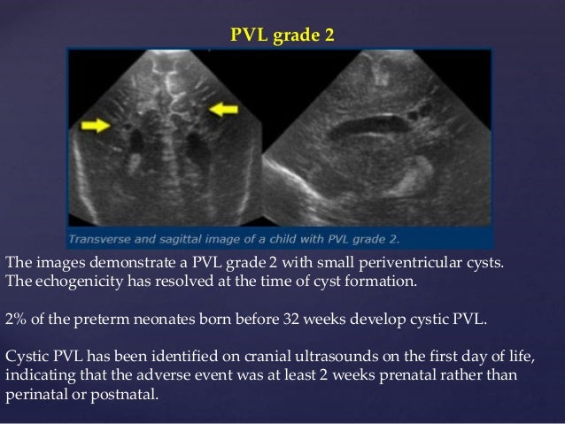 Intracranial ultrasound