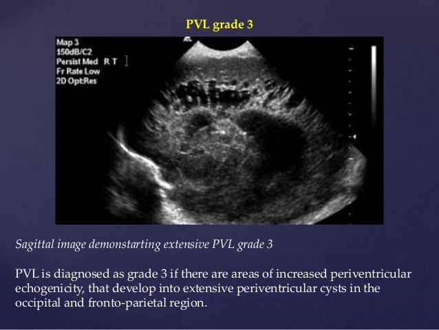 Intracranial ultrasound