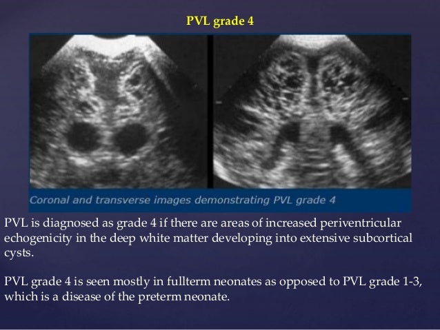 Intracranial ultrasound