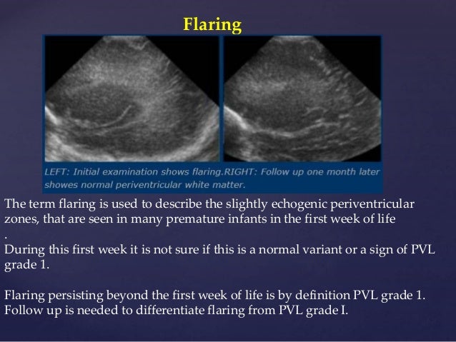 Intracranial ultrasound