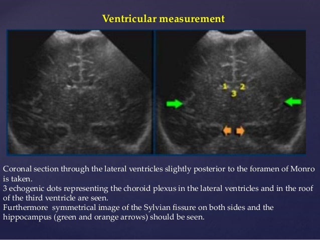 Intracranial ultrasound