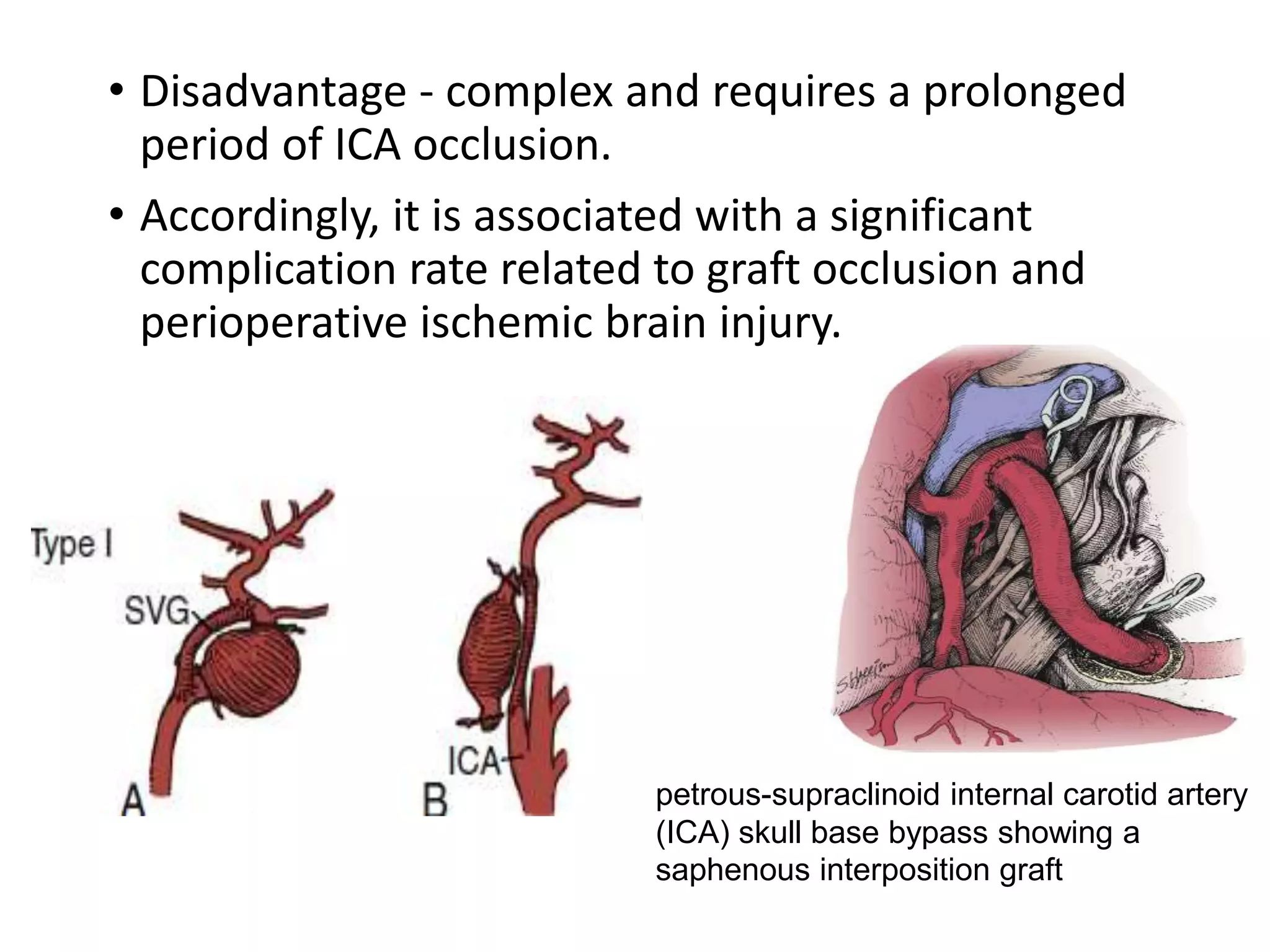 Intracranial Vascular Bypass.pptx