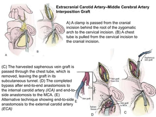 Intracranial Vascular Bypass.pptx
